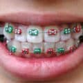 Do Braces Make the Roots of Your Teeth Shorter?