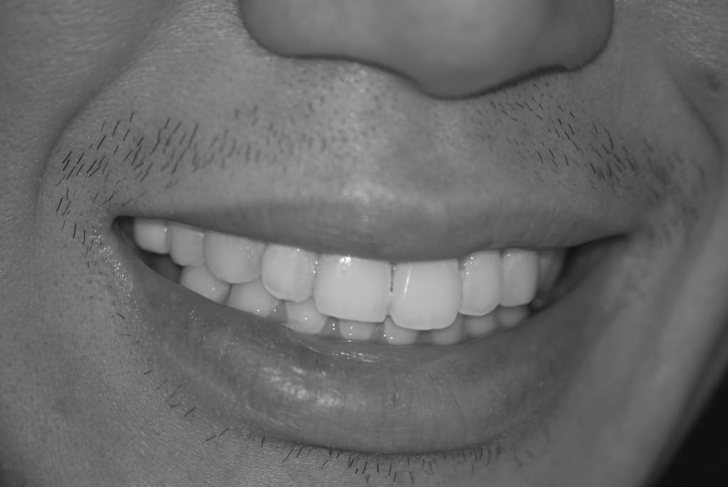 Do Braces Make the Roots of Your Teeth Shorter?