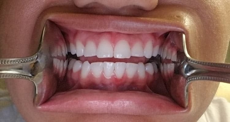 Does Invisalign Cause Gum Recession? (2025 Guide) Invisalign Bleeding?