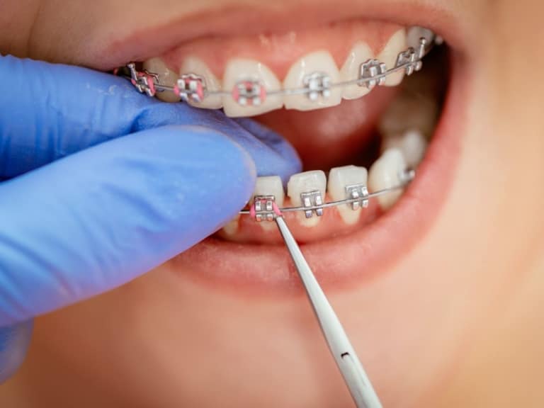 Do Braces Make the Roots of Your Teeth Shorter? (We answer)